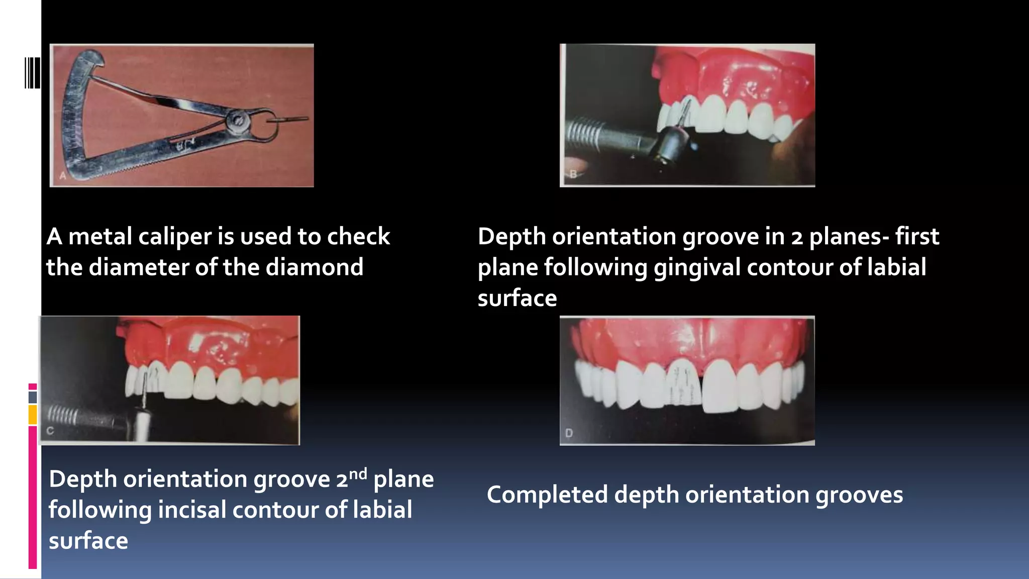 Tooth Preparation for full veneer crown | PPTX
