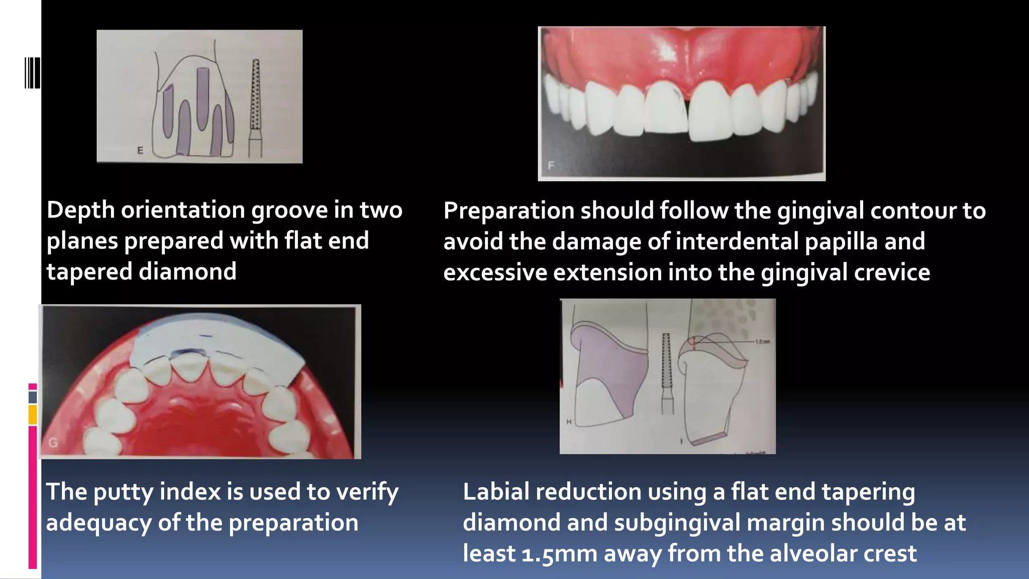 Tooth Preparation for full veneer crown | PPTX