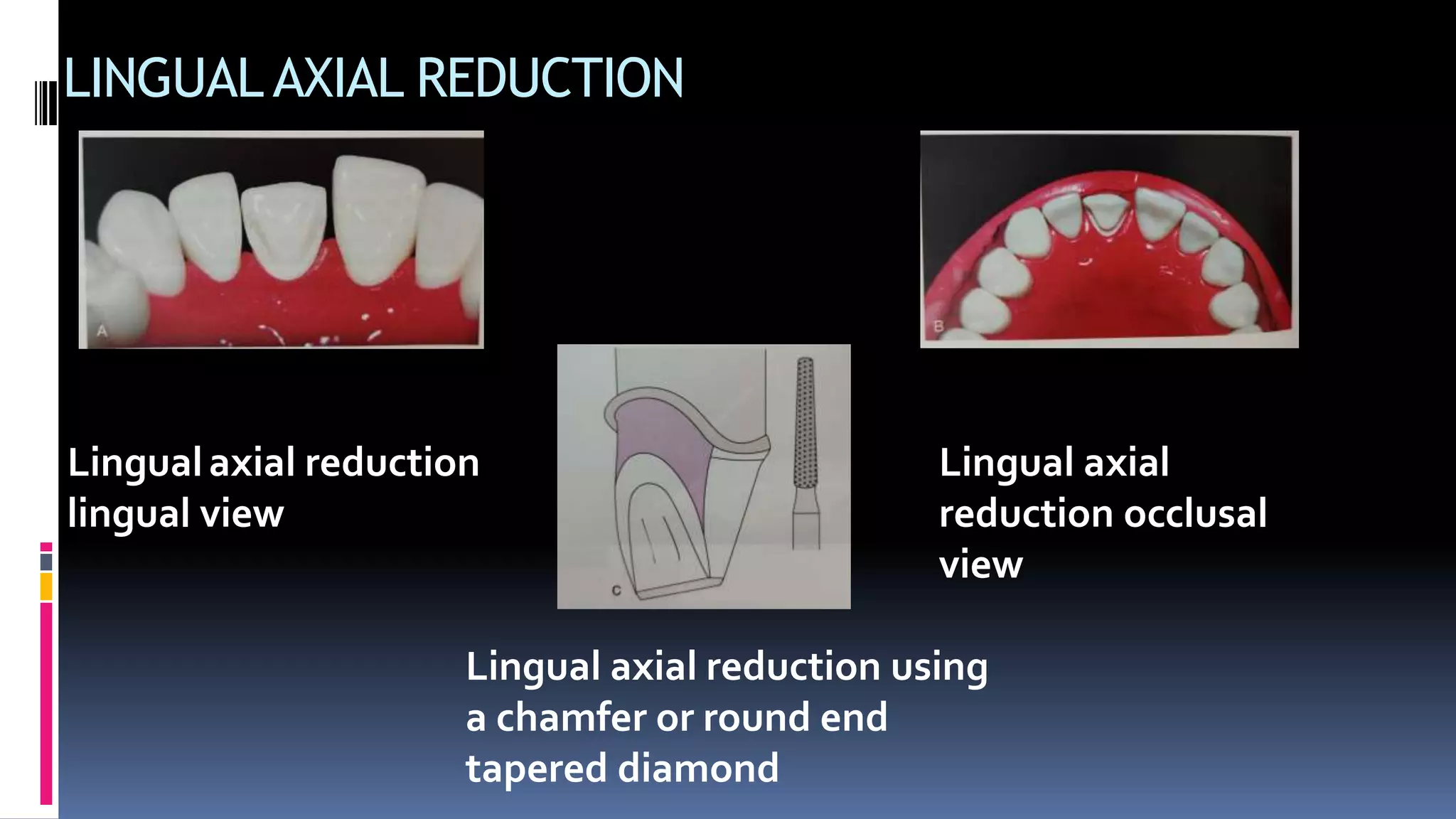 Tooth Preparation for full veneer crown | PPTX