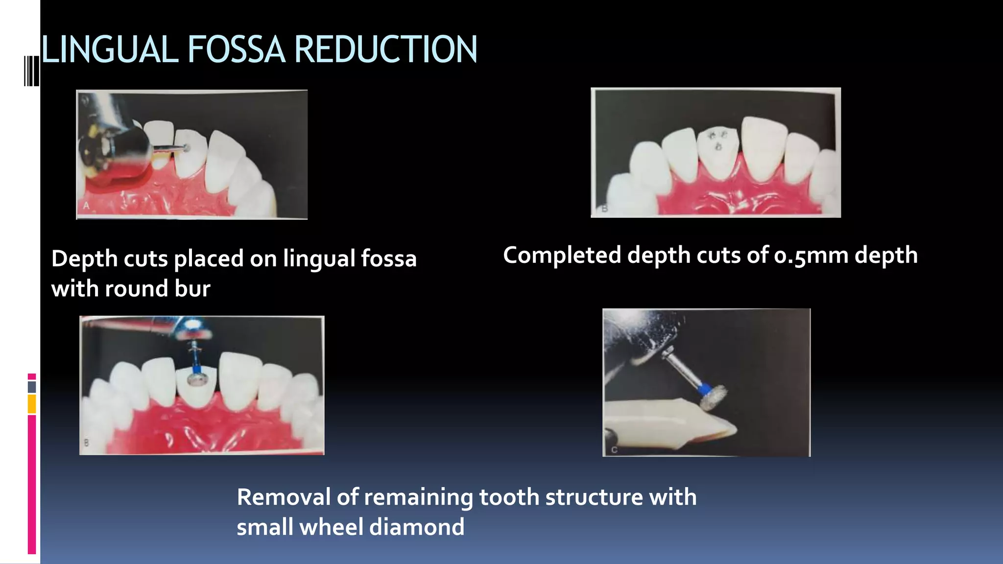 Tooth Preparation for full veneer crown | PPTX