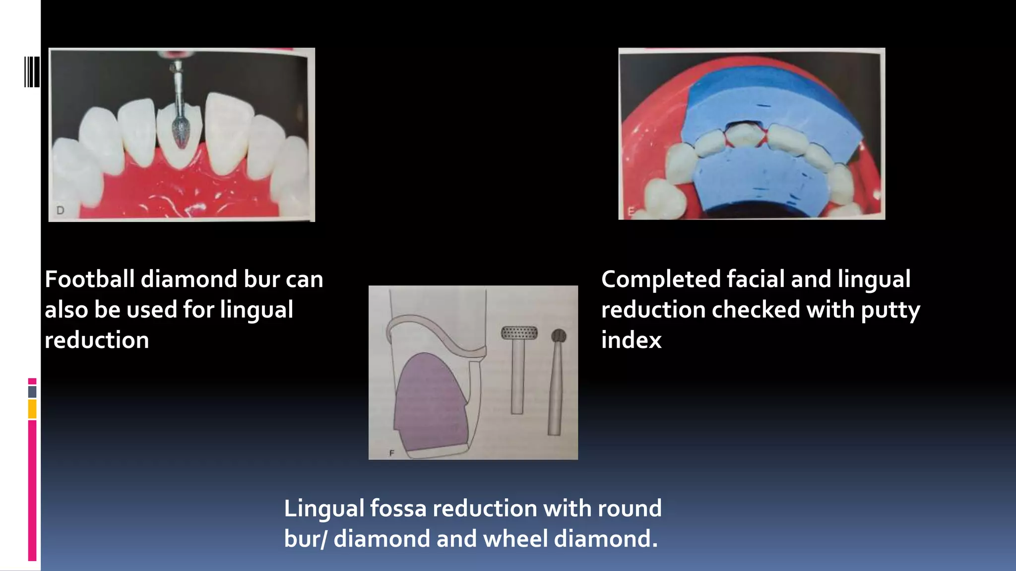 Tooth Preparation for full veneer crown | PPTX
