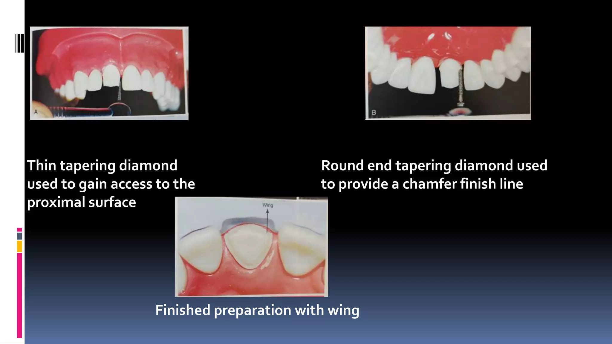 Tooth Preparation for full veneer crown | PPTX