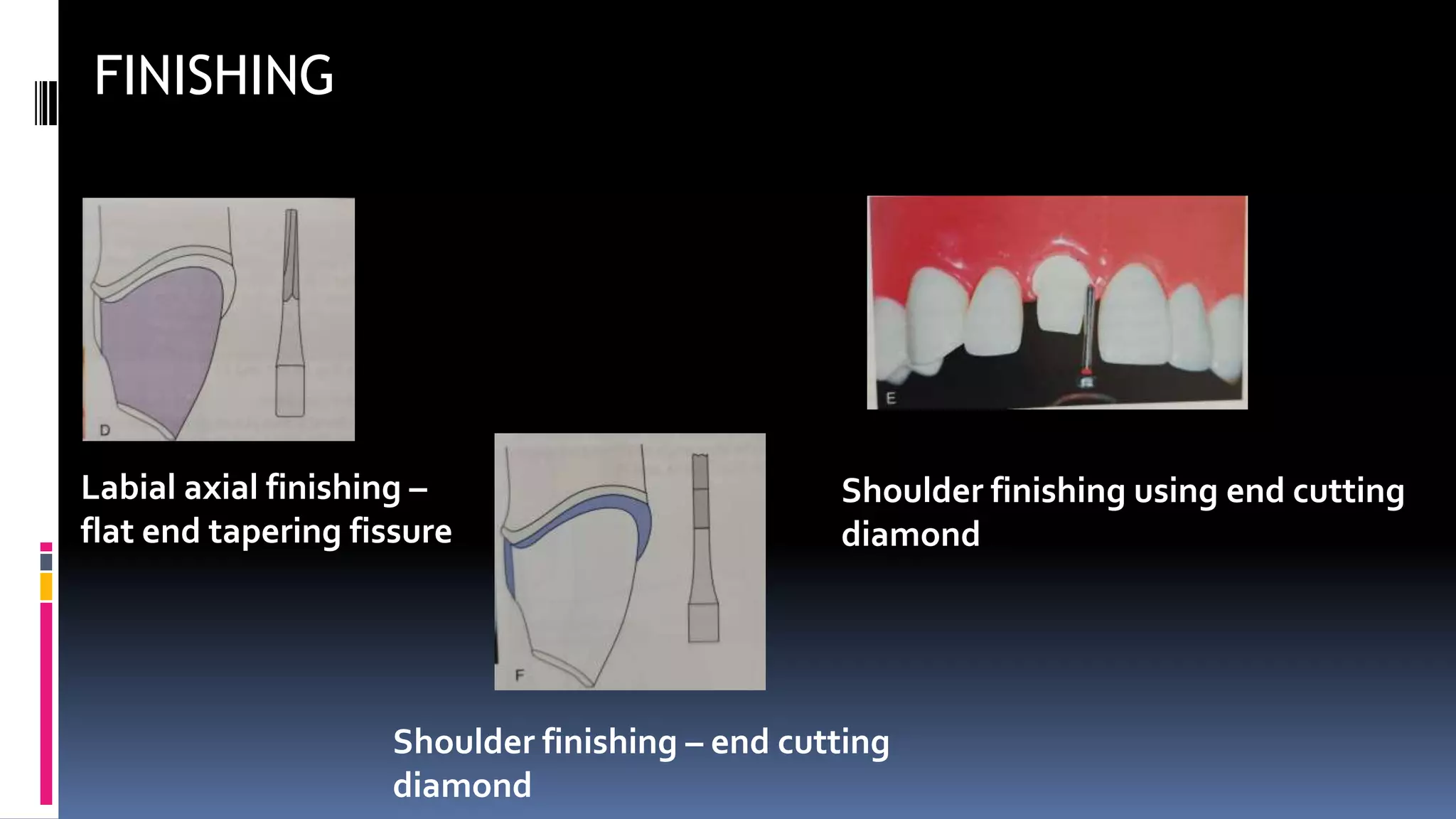 Tooth Preparation for full veneer crown | PPTX