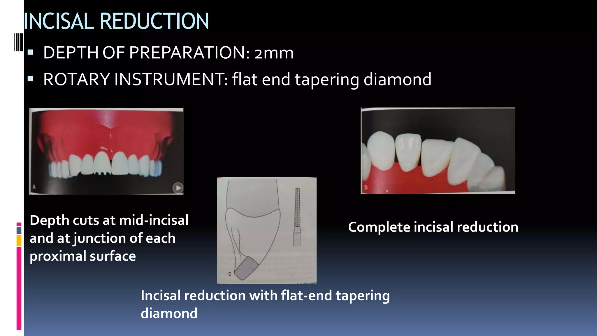 Tooth Preparation for full veneer crown | PPTX