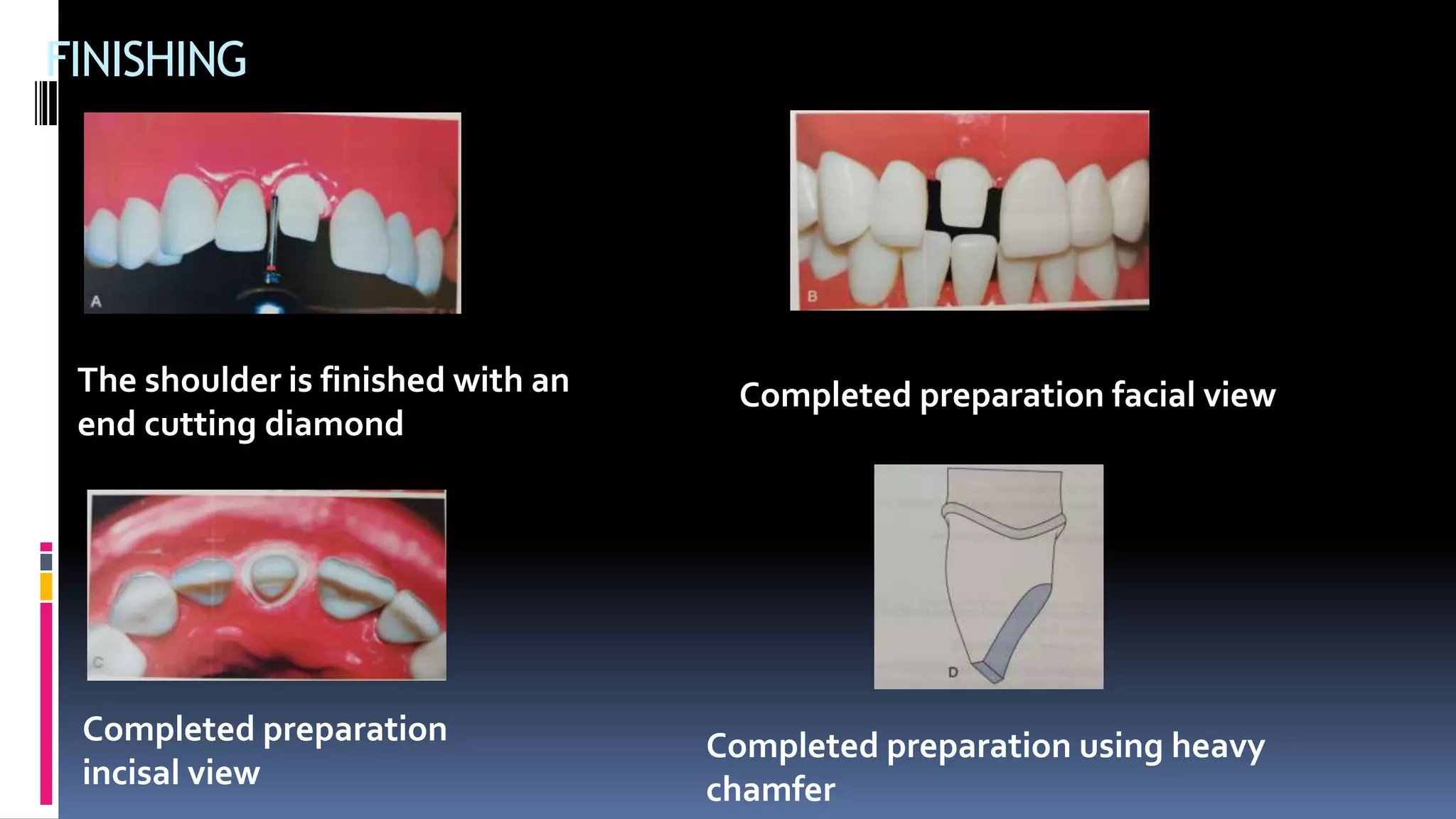 Tooth Preparation for full veneer crown | PPTX