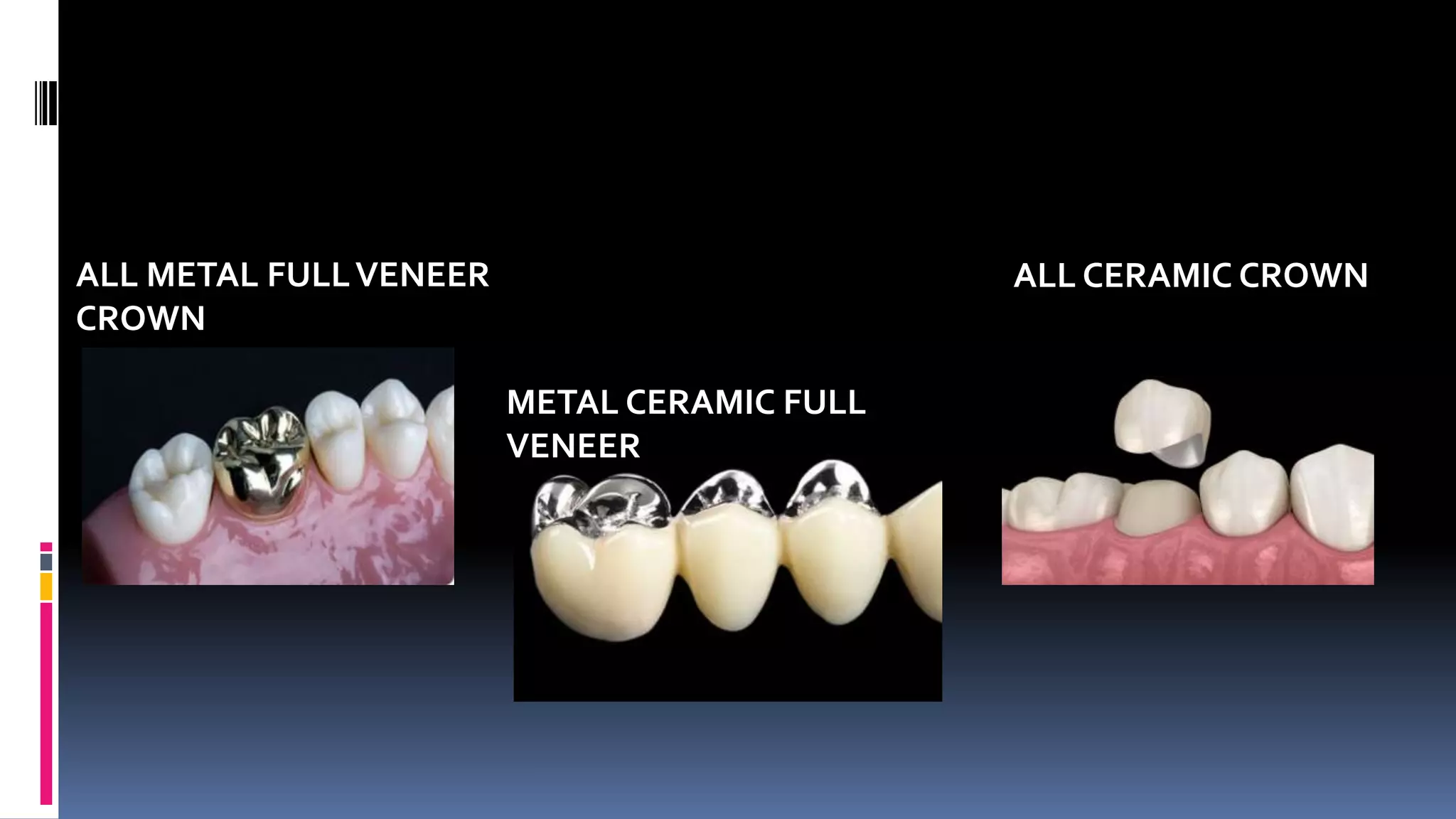 Tooth Preparation for full veneer crown | PPTX