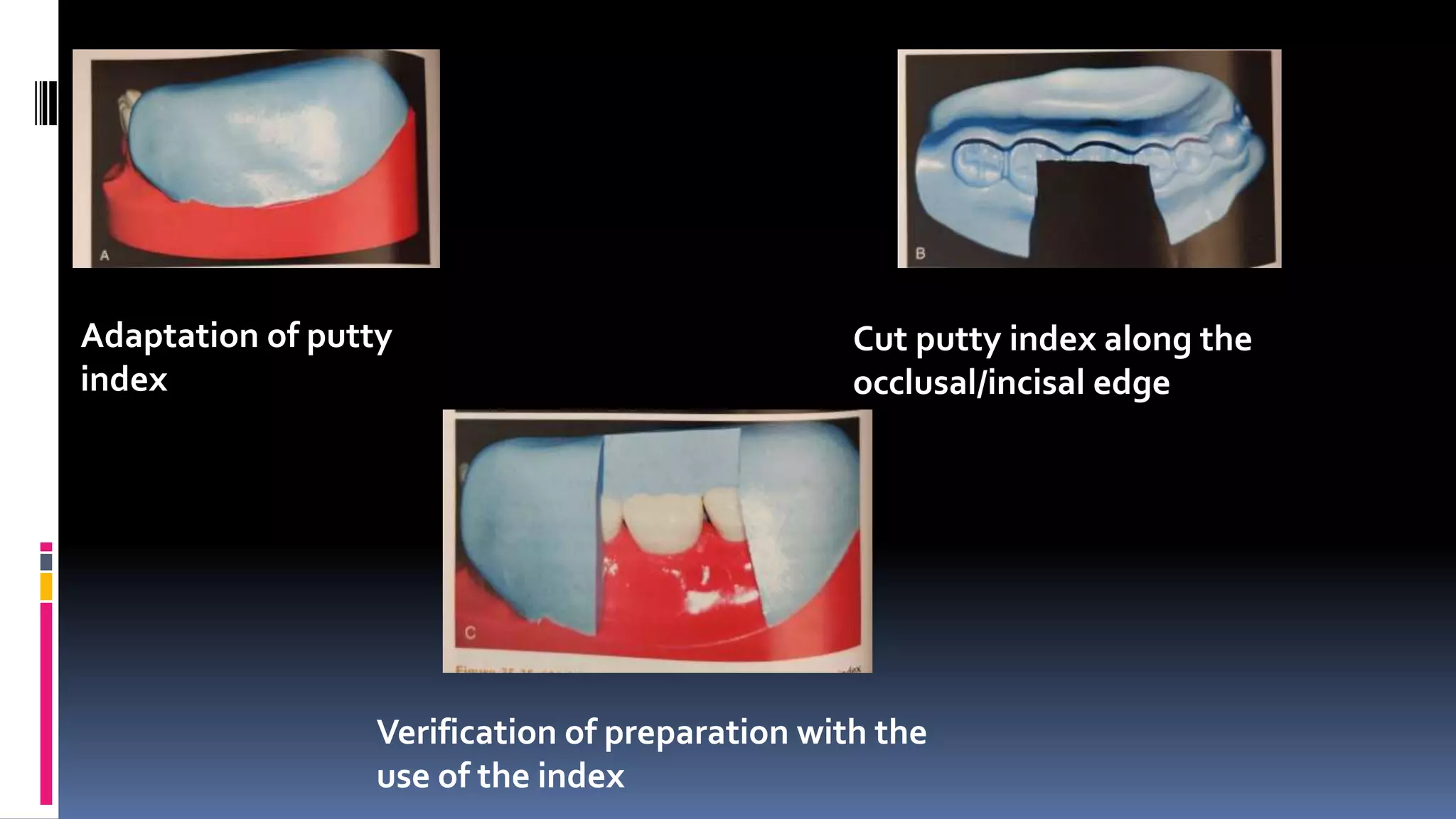 Tooth Preparation for full veneer crown | PPTX