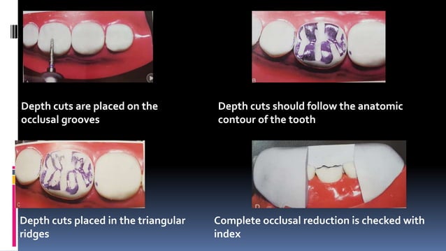 Tooth Preparation for full veneer crown | PPTX | Dental Health ...