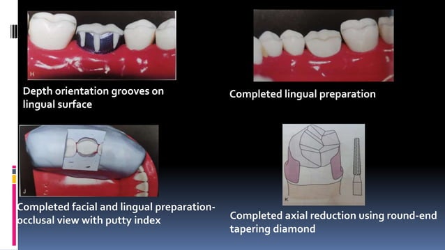 Tooth Preparation for full veneer crown | PPTX | Dental Health ...