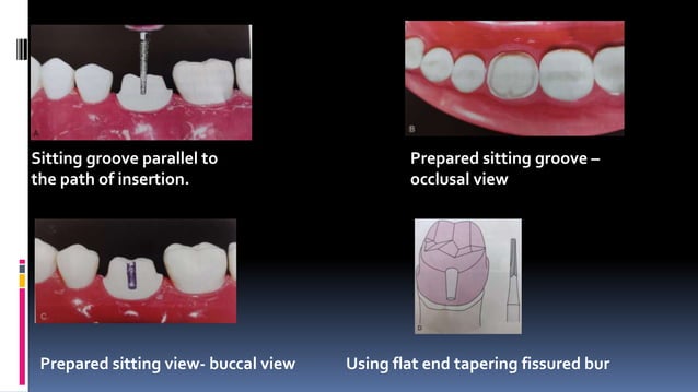 Tooth Preparation for full veneer crown | PPTX | Dental Health ...