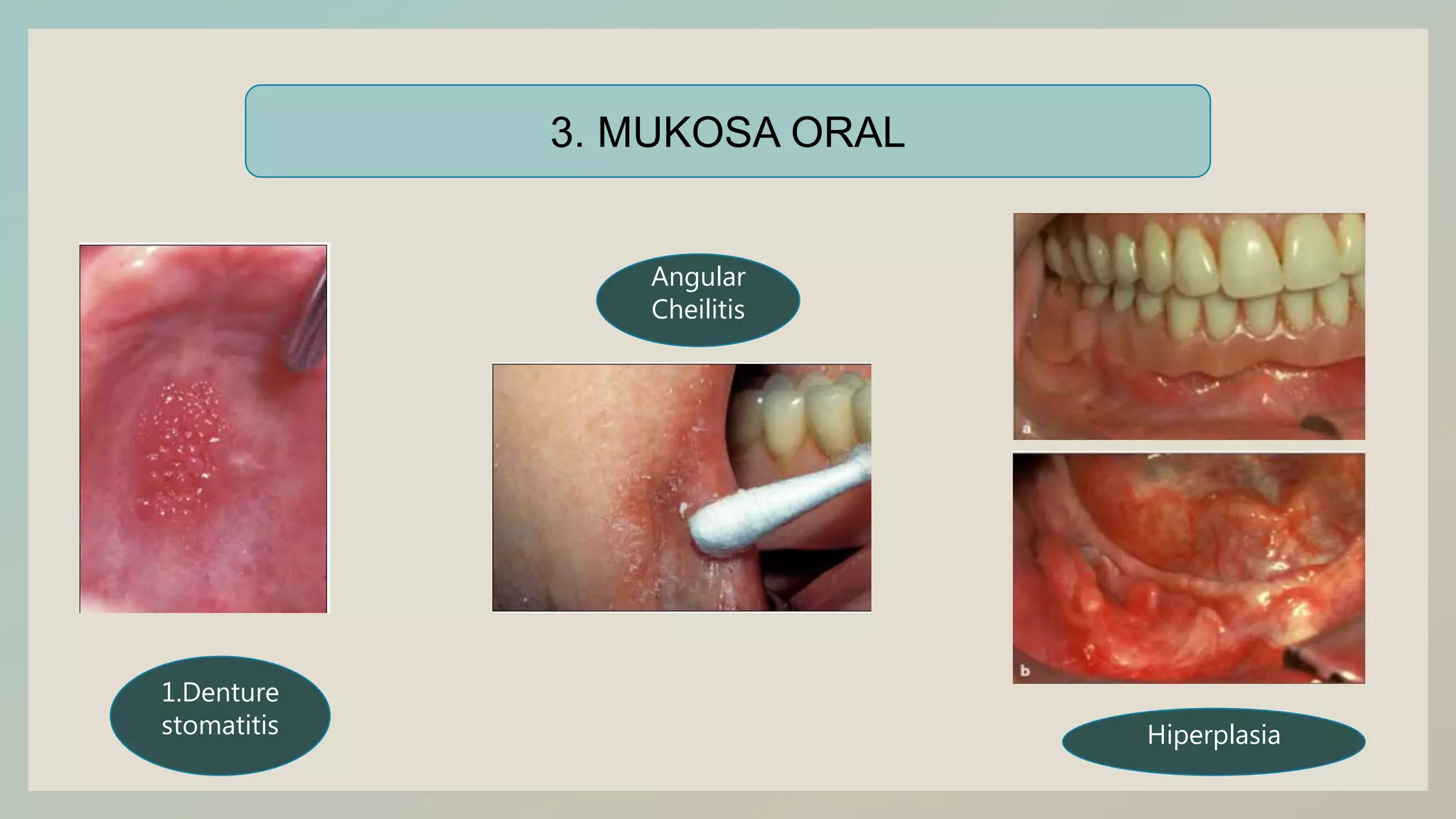 Complete denture chapter 1, nurimah wahyuni | PPTX