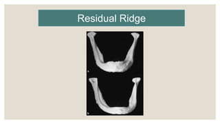 Complete denture chapter 1, nurimah wahyuni | PPTX