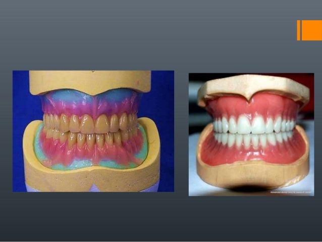 Complete denture fabrication By Dr. Armaan Singh Complete denture fabrication By Dr. Armaan Singh