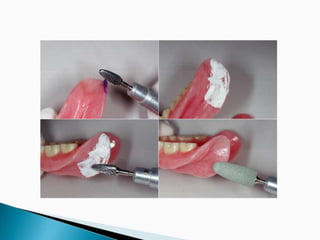 Complete denture instructions | PPTX