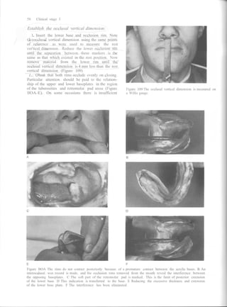 Complete denture prosthetics | PDF