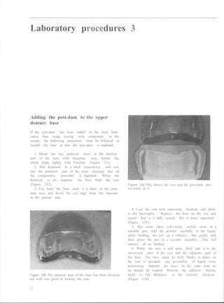 Complete denture prosthetics | PDF