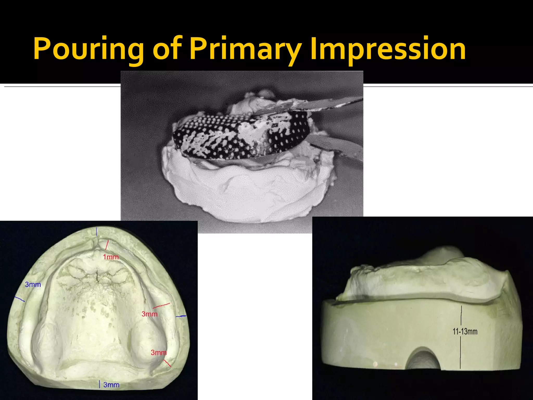 Complete denture prosthodontics step by step | PPT