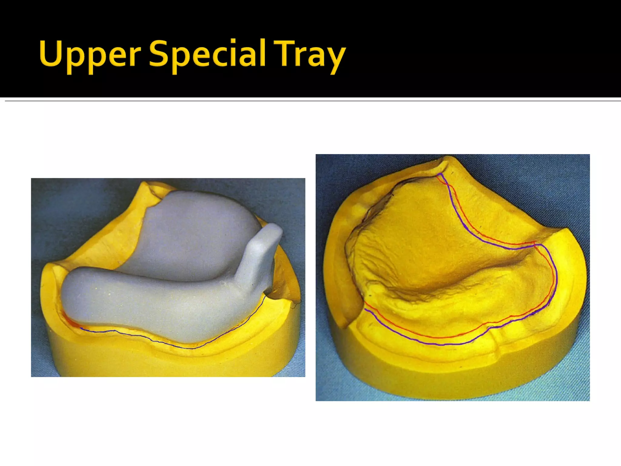 Complete denture prosthodontics step by step | PPT
