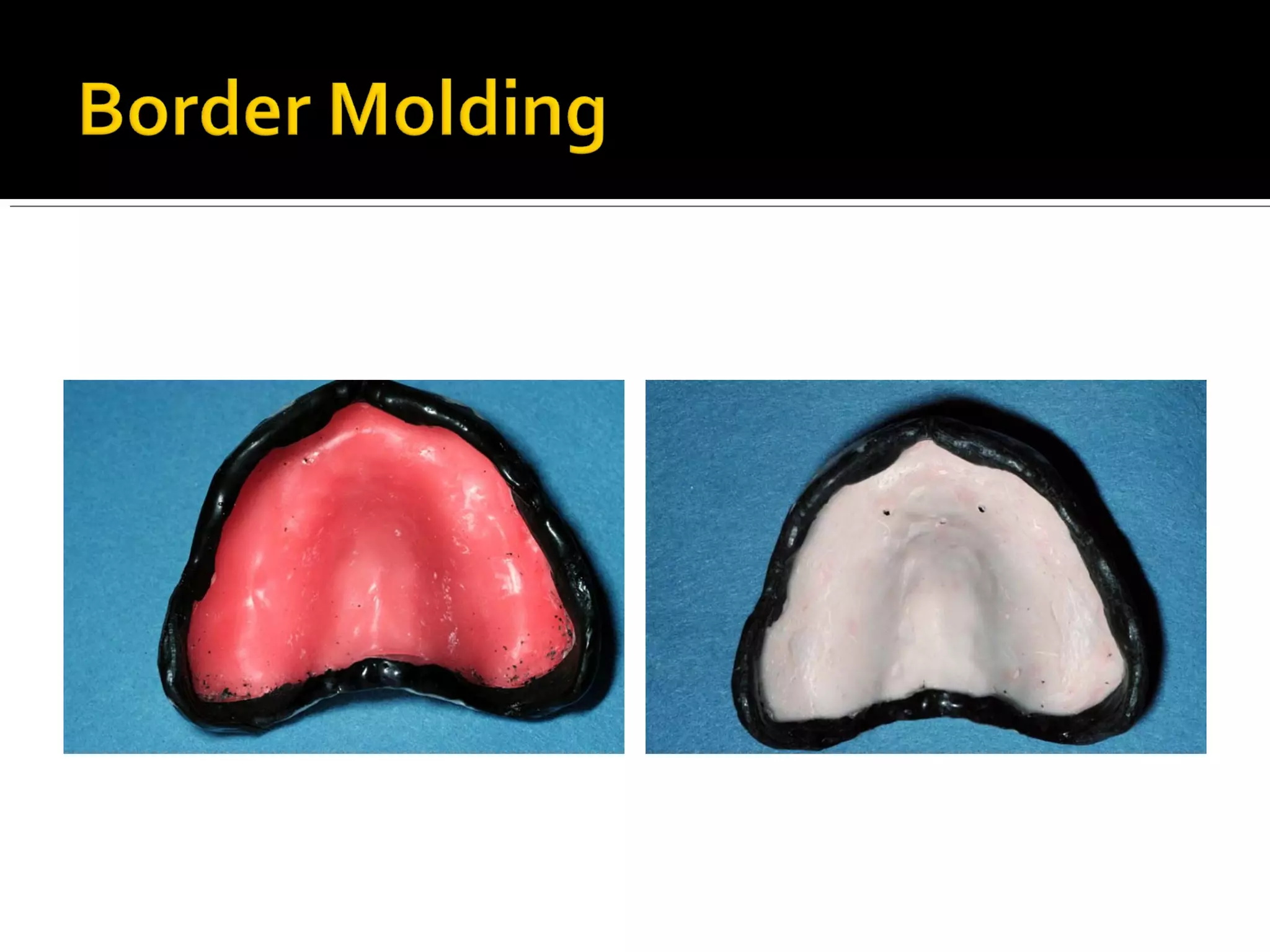 Complete denture prosthodontics step by step | PPT