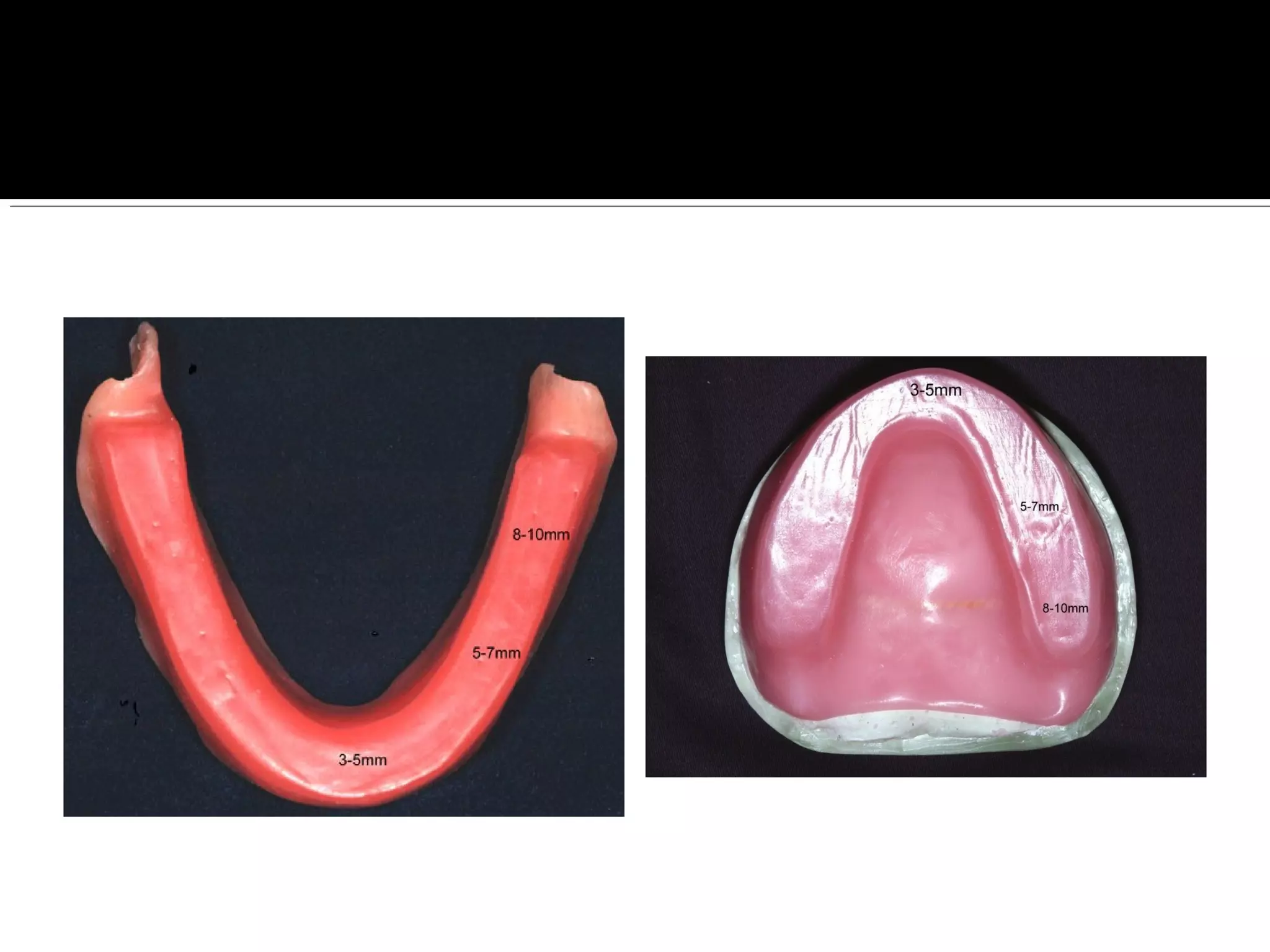 Complete denture prosthodontics step by step | PPT