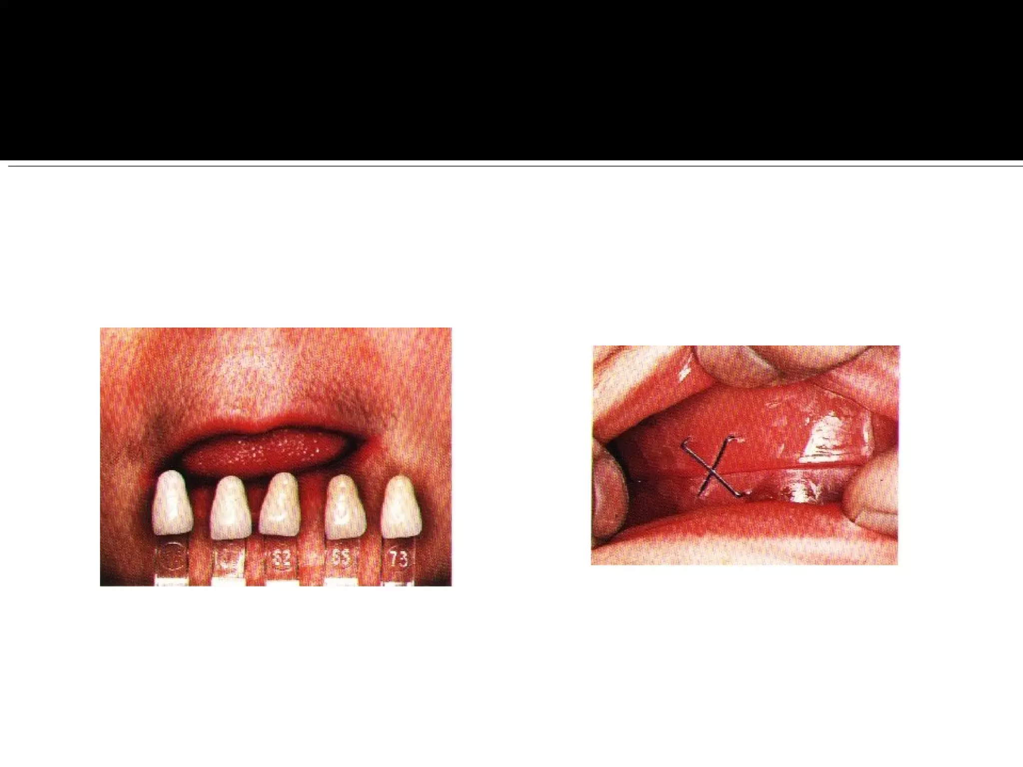 Complete denture prosthodontics step by step | PPT