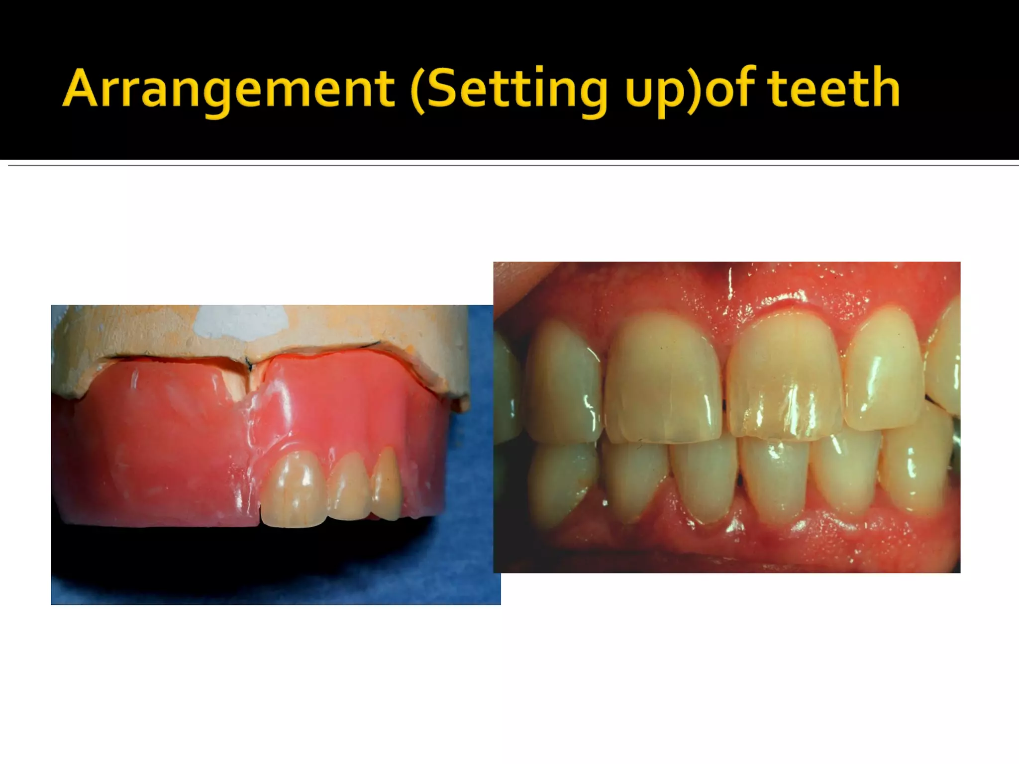Complete denture prosthodontics step by step | PPT