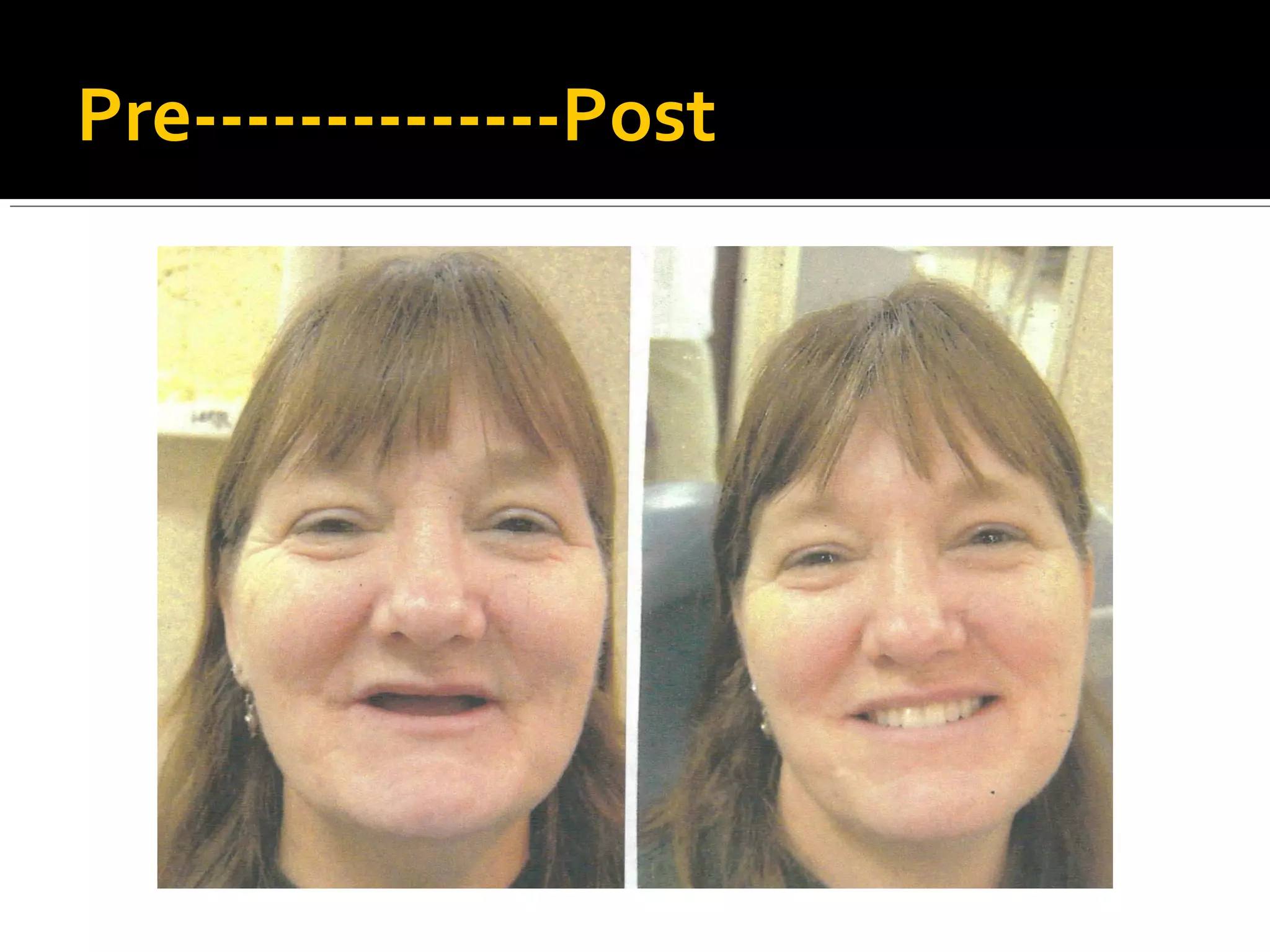 Complete denture prosthodontics step by step | PPT
