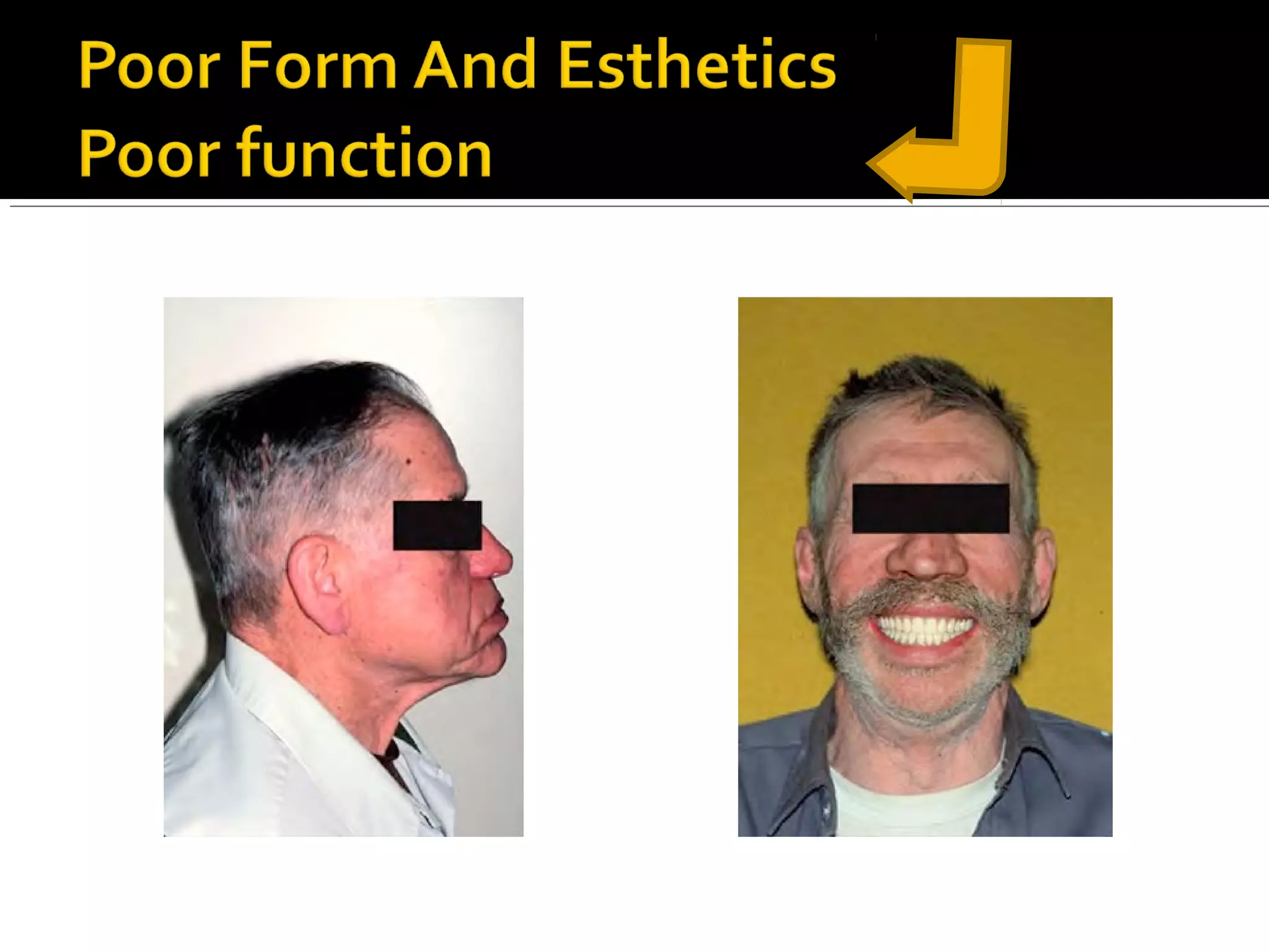 Complete denture prosthodontics step by step | PPT