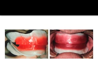 Complete denture prosthodontics step by step | PPT