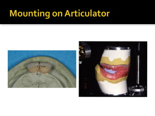 Complete denture prosthodontics step by step | PPT