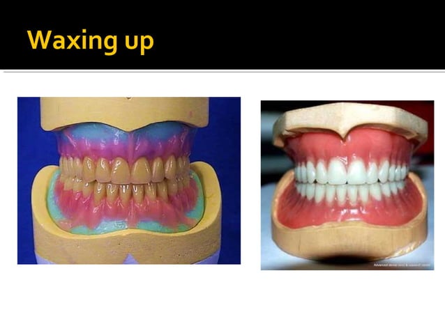 Complete denture prosthodontics step by step | PPT | Dental Health ...