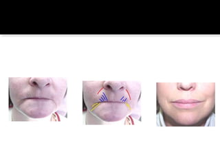 Complete denture prosthodontics step by step | PPT