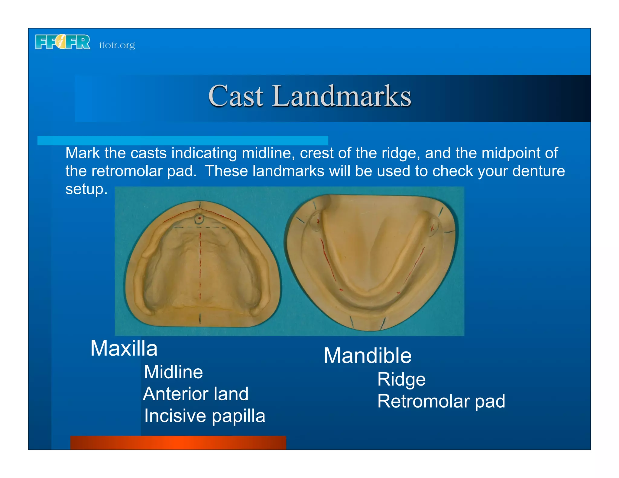 Complete dentures 16.occlusal schemes lingualized occlusion | PDF