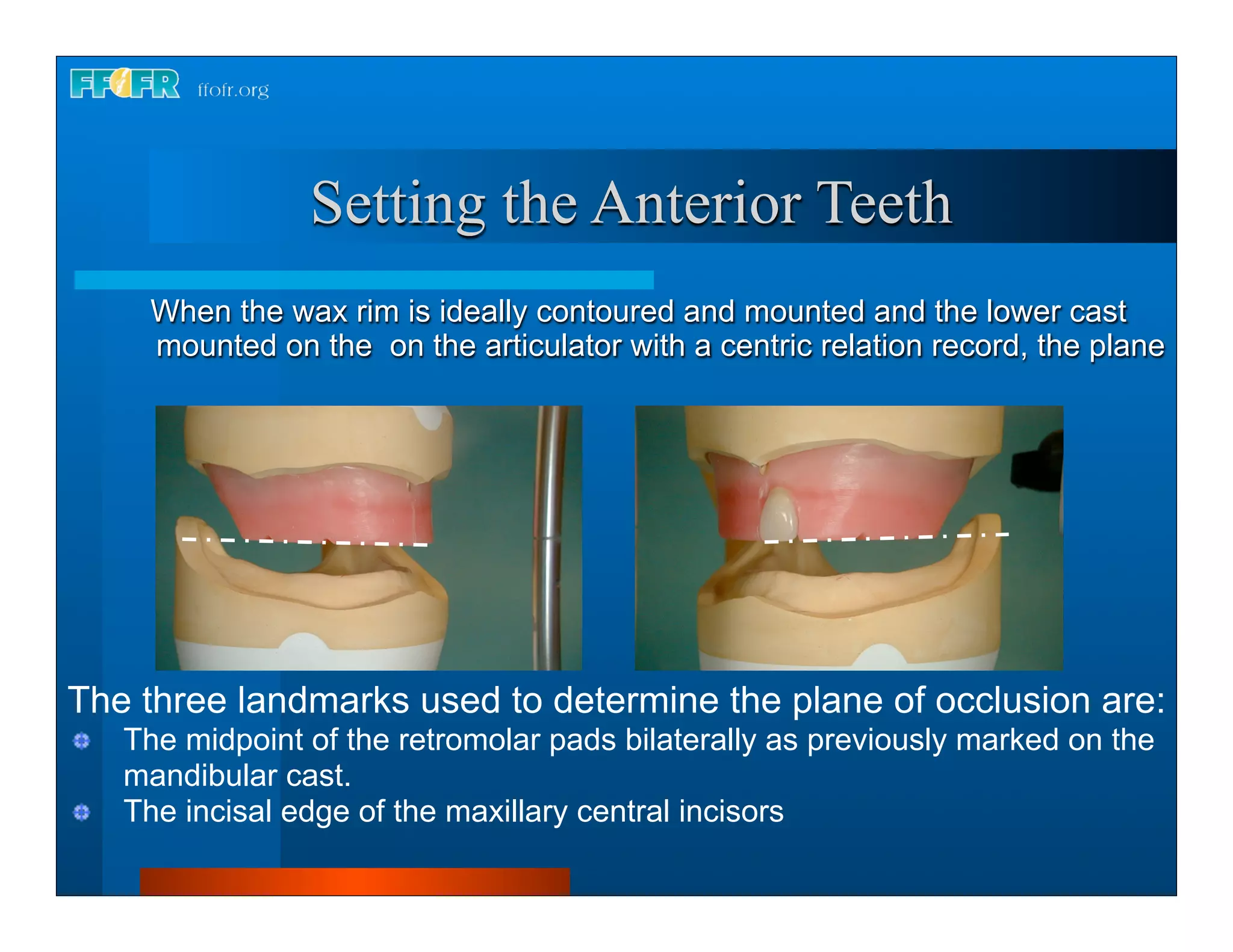 Complete dentures 16.occlusal schemes lingualized occlusion | PDF