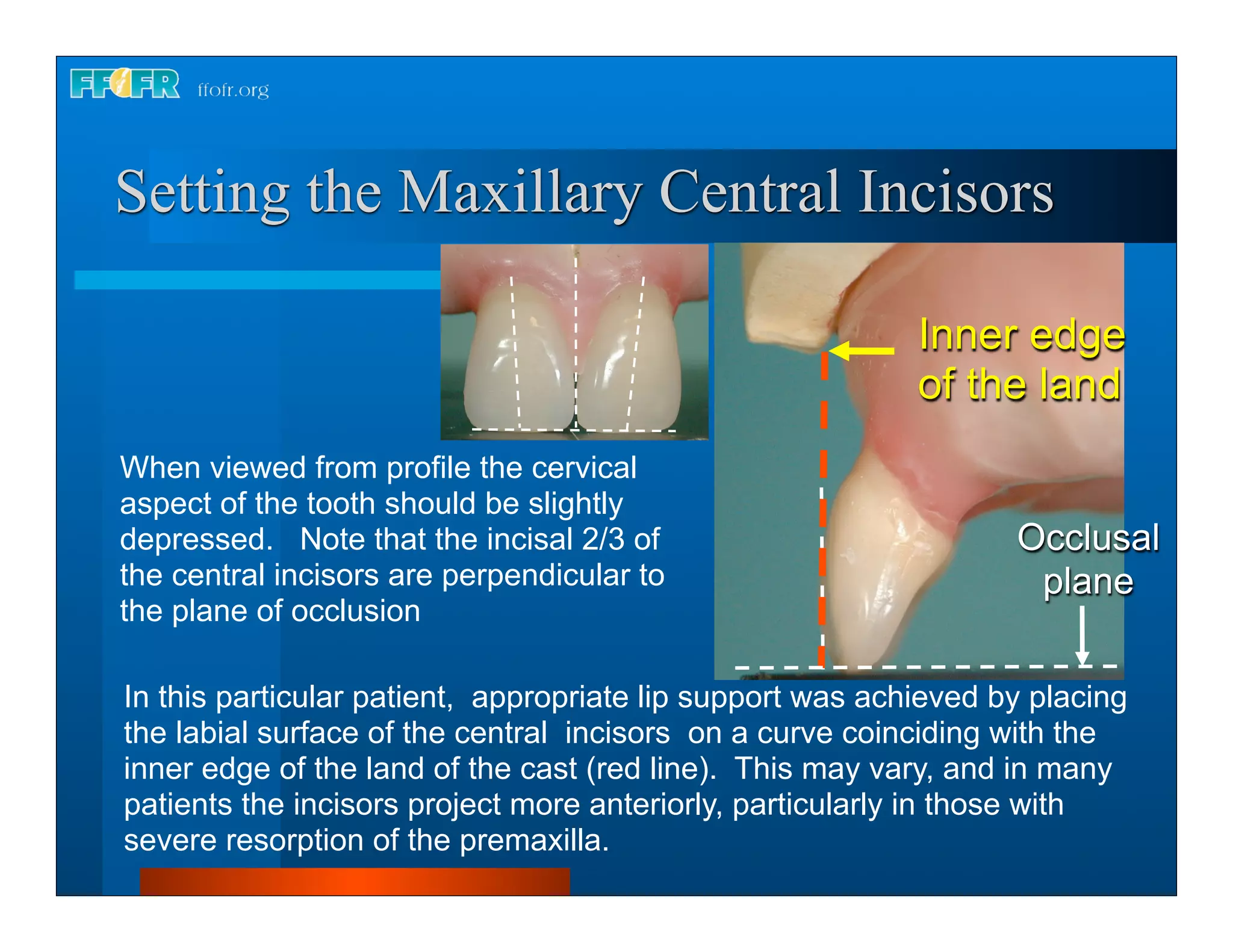 Complete dentures 16.occlusal schemes lingualized occlusion | PDF
