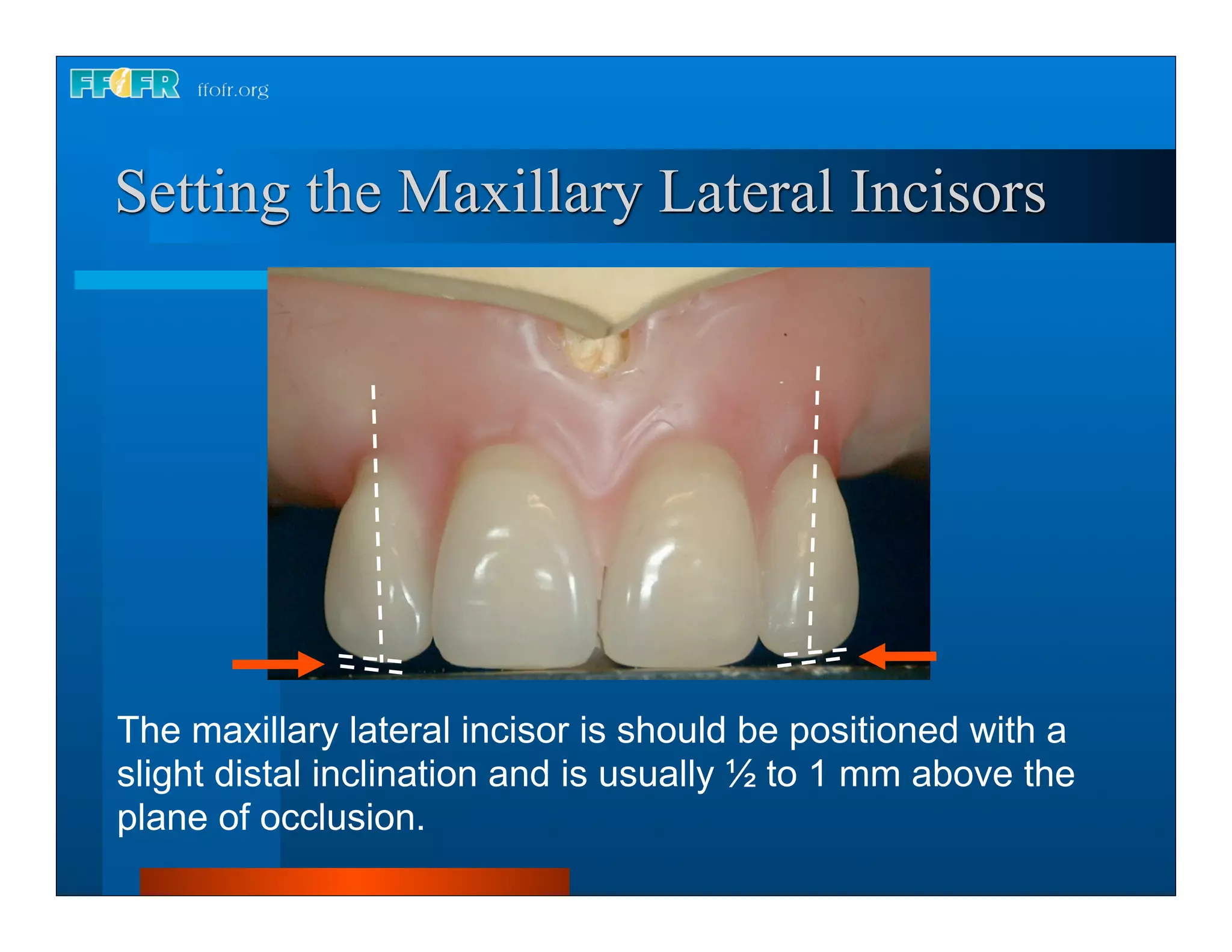 Complete dentures 16.occlusal schemes lingualized occlusion | PDF