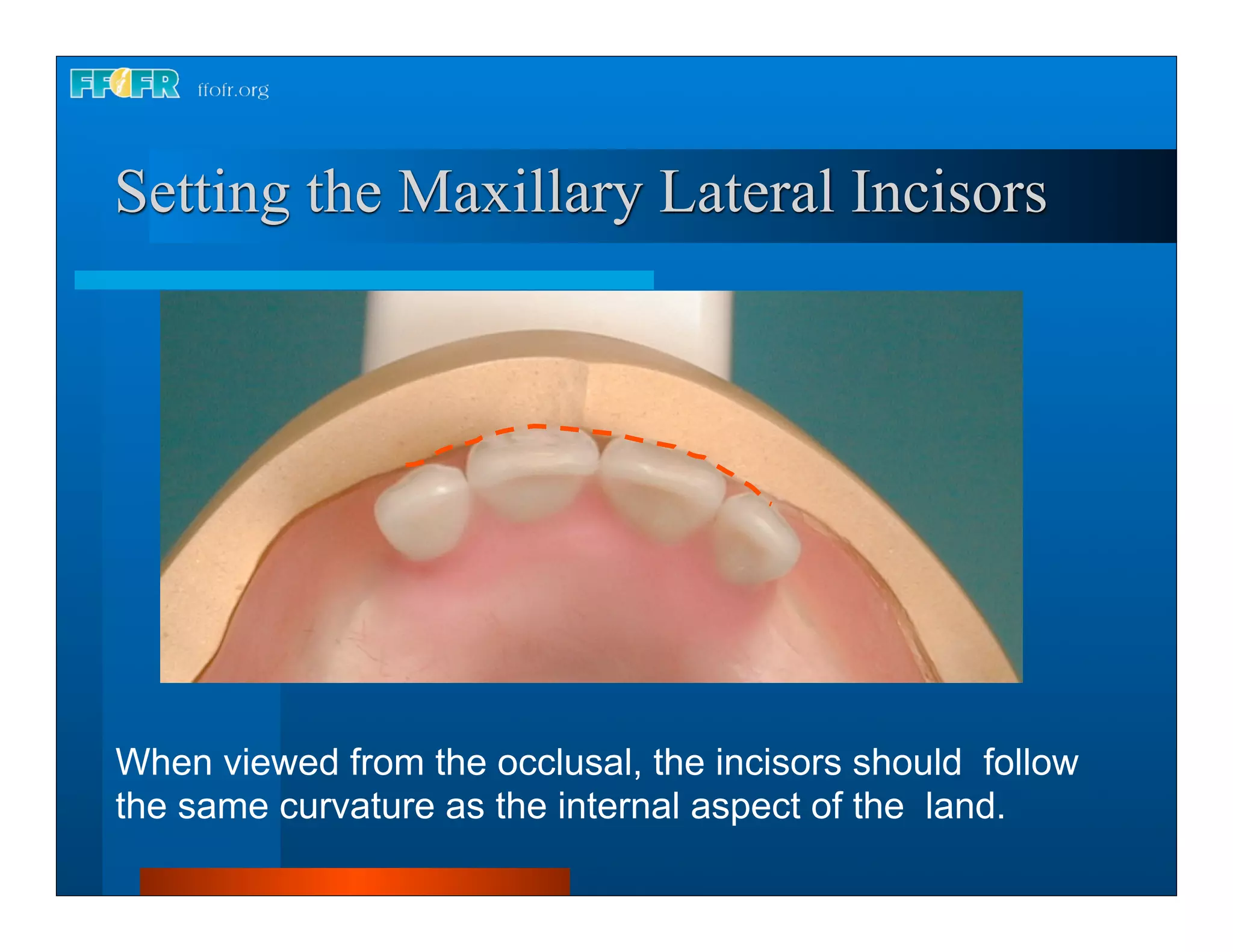 Complete dentures 16.occlusal schemes lingualized occlusion | PDF