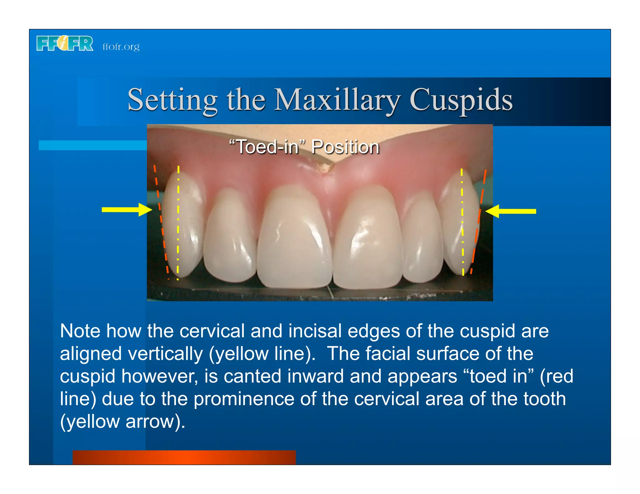 Complete dentures 16.occlusal schemes lingualized occlusion | PDF