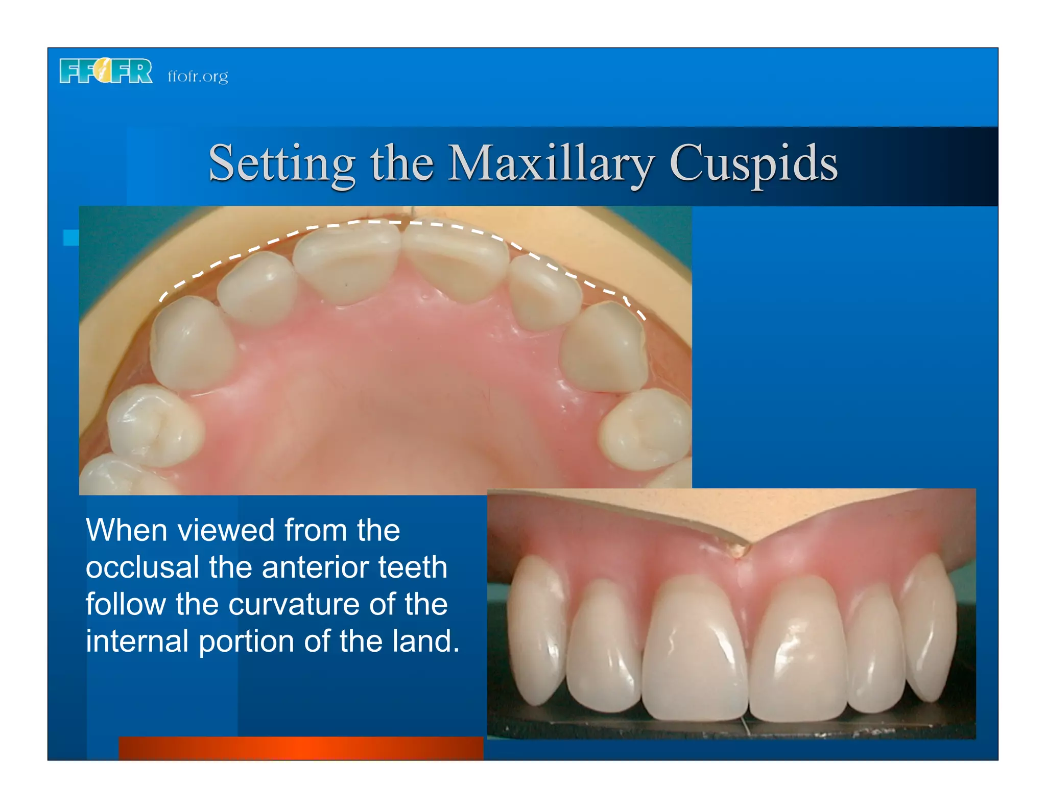 Complete dentures 16.occlusal schemes lingualized occlusion | PDF