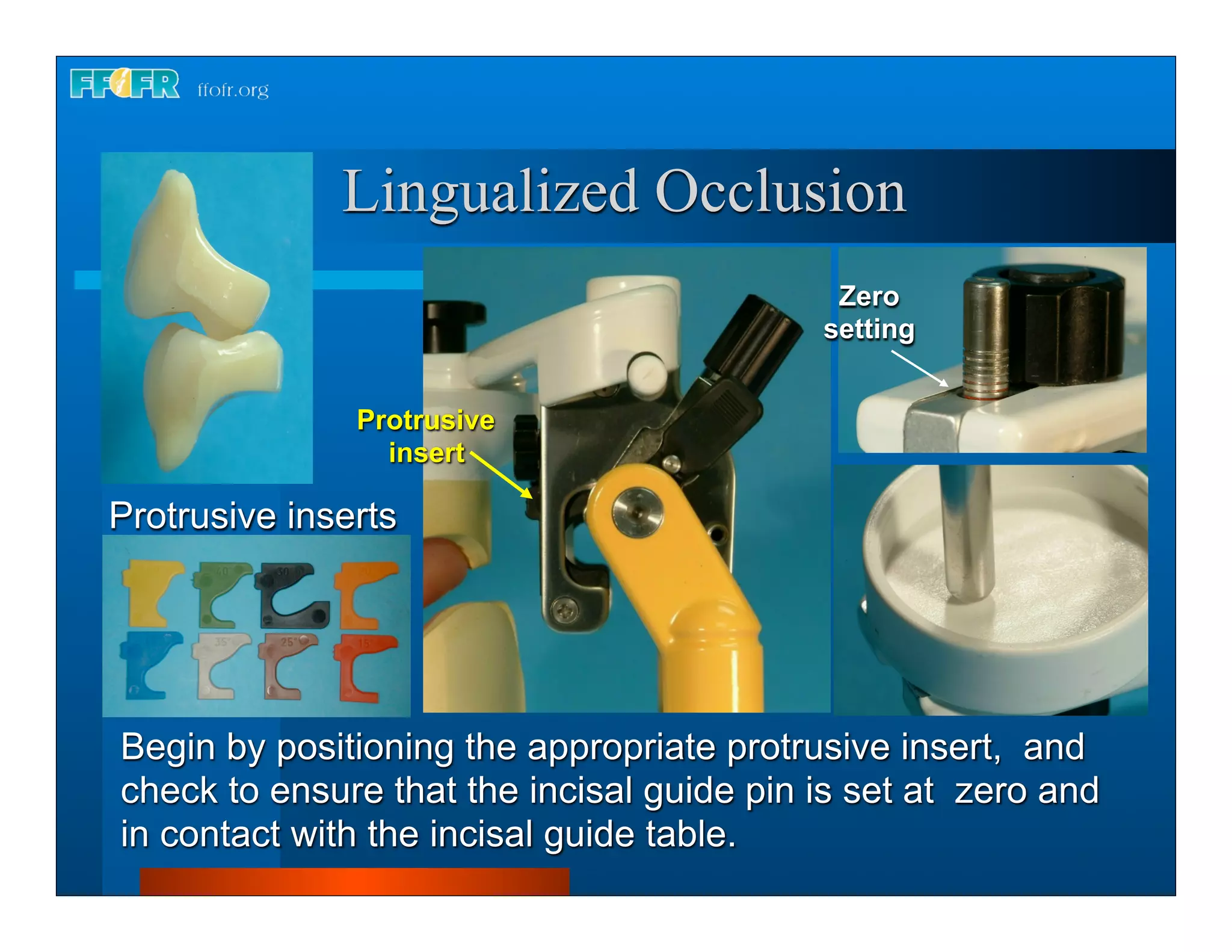 Complete dentures 16.occlusal schemes lingualized occlusion | PDF