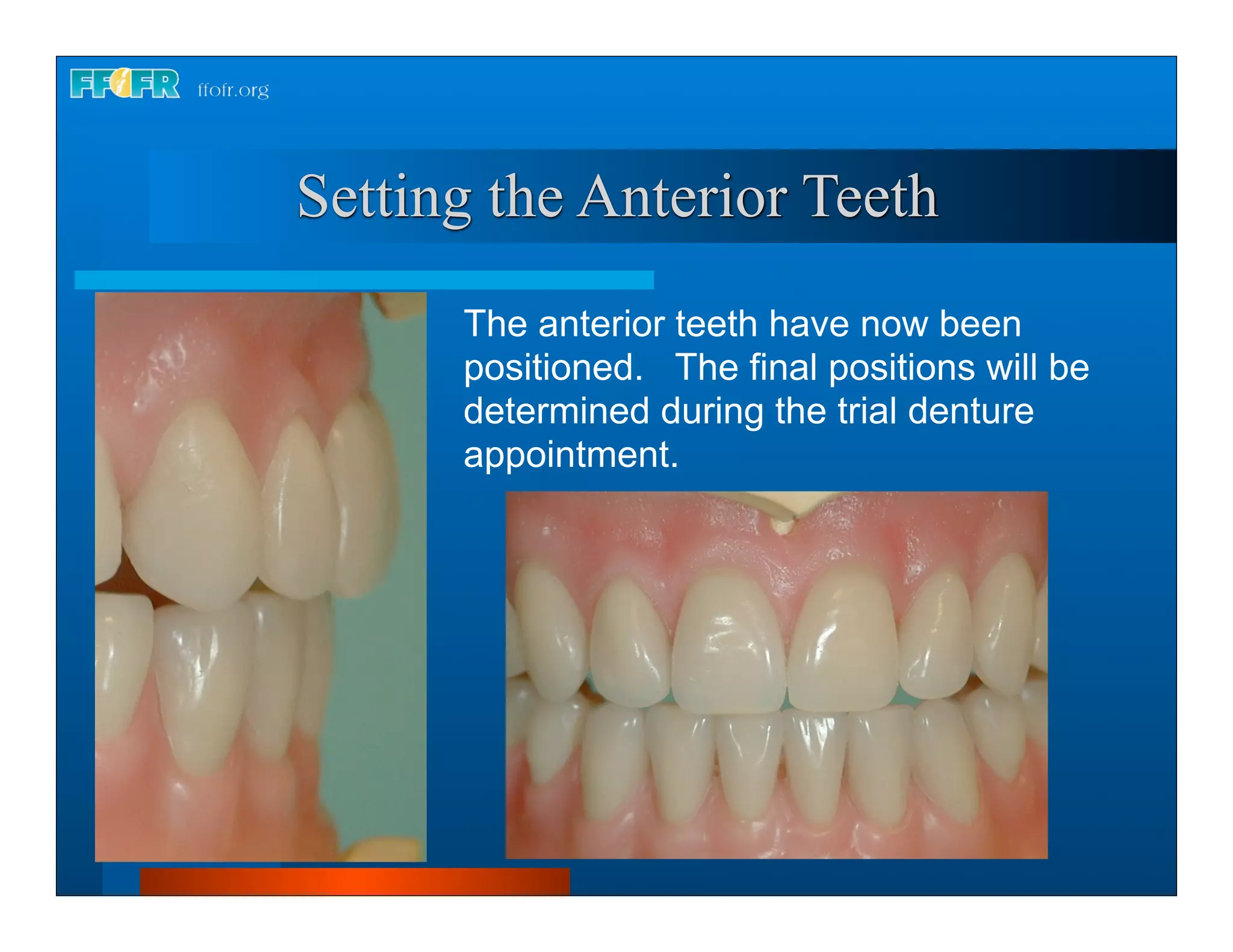 Complete dentures 16.occlusal schemes lingualized occlusion | PDF
