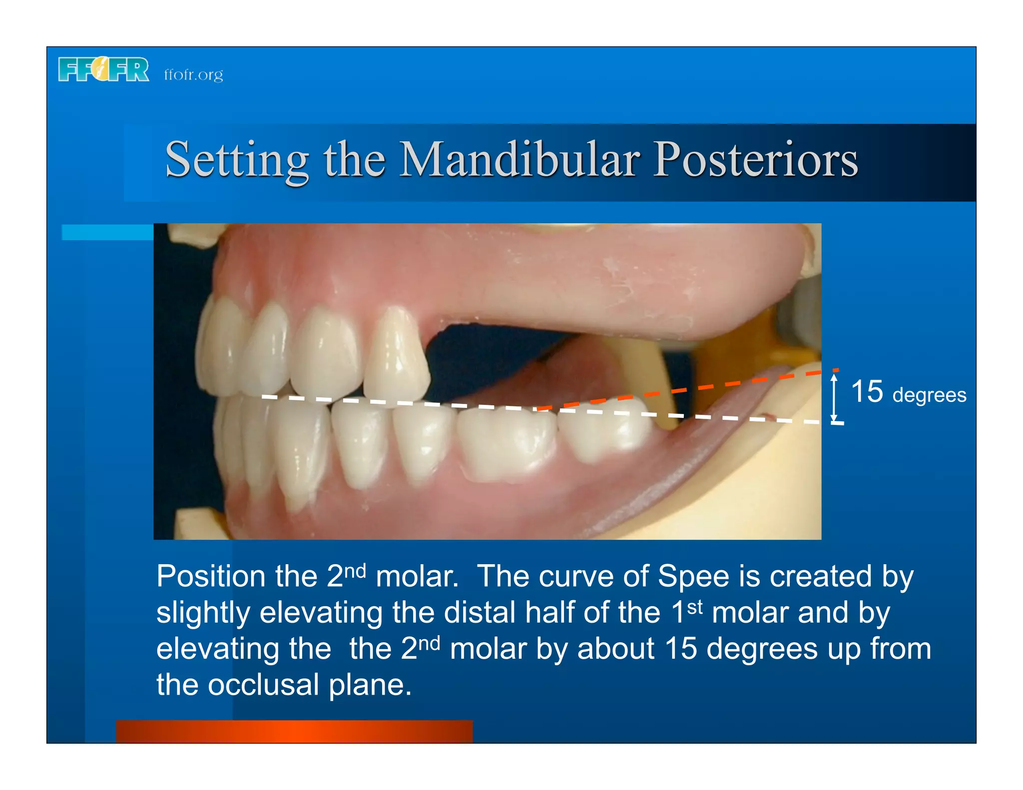 Complete dentures 16.occlusal schemes lingualized occlusion | PDF