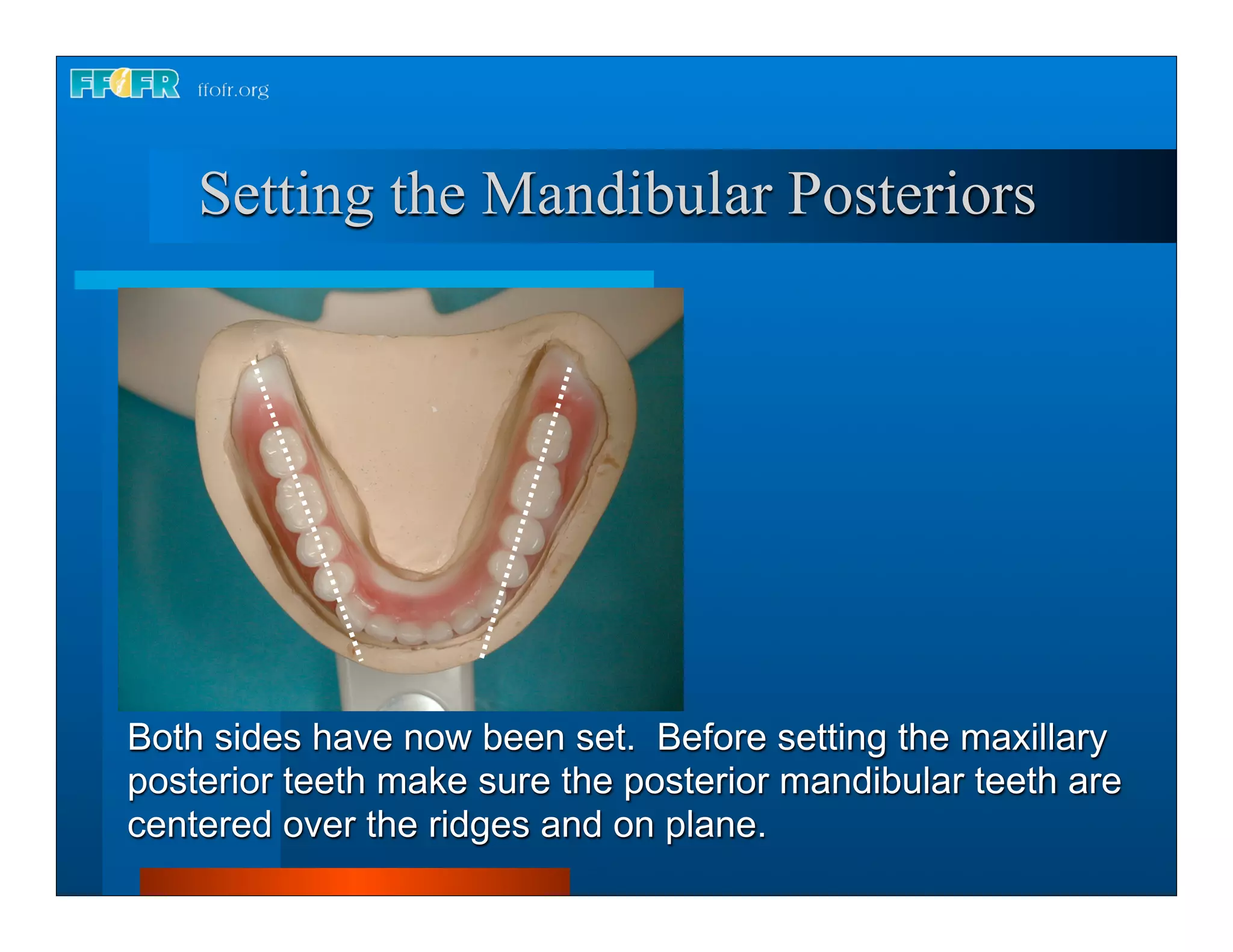 Complete dentures 16.occlusal schemes lingualized occlusion | PDF