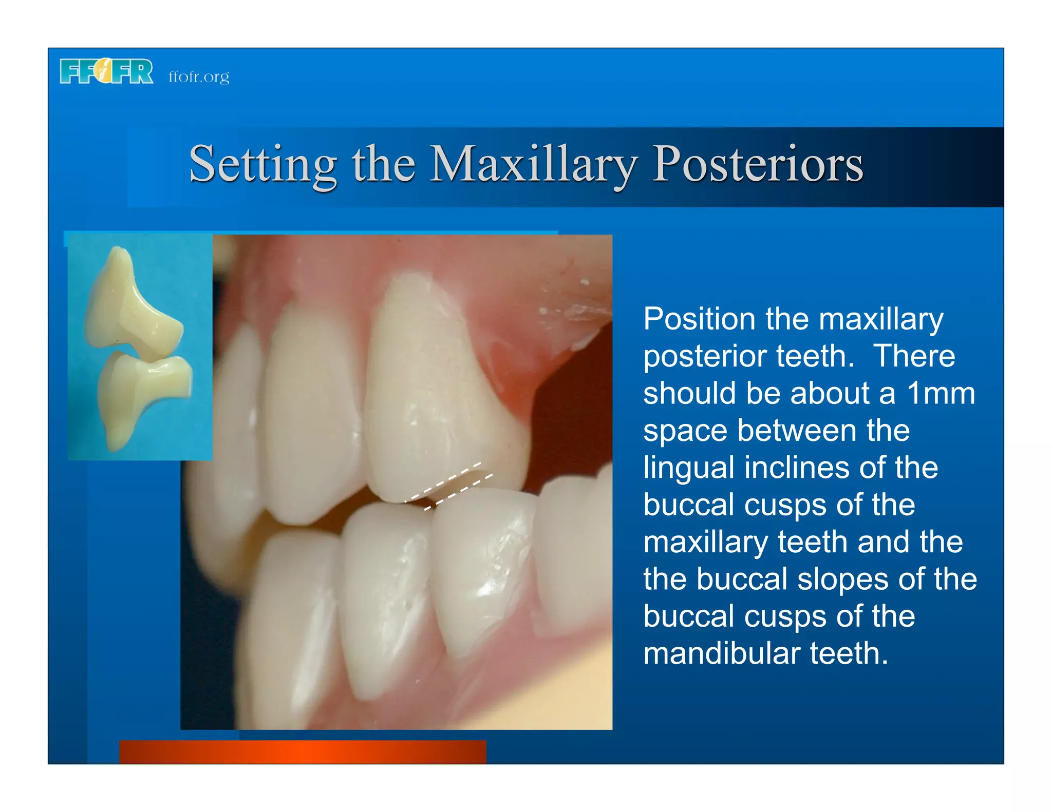 Complete dentures 16.occlusal schemes lingualized occlusion | PDF