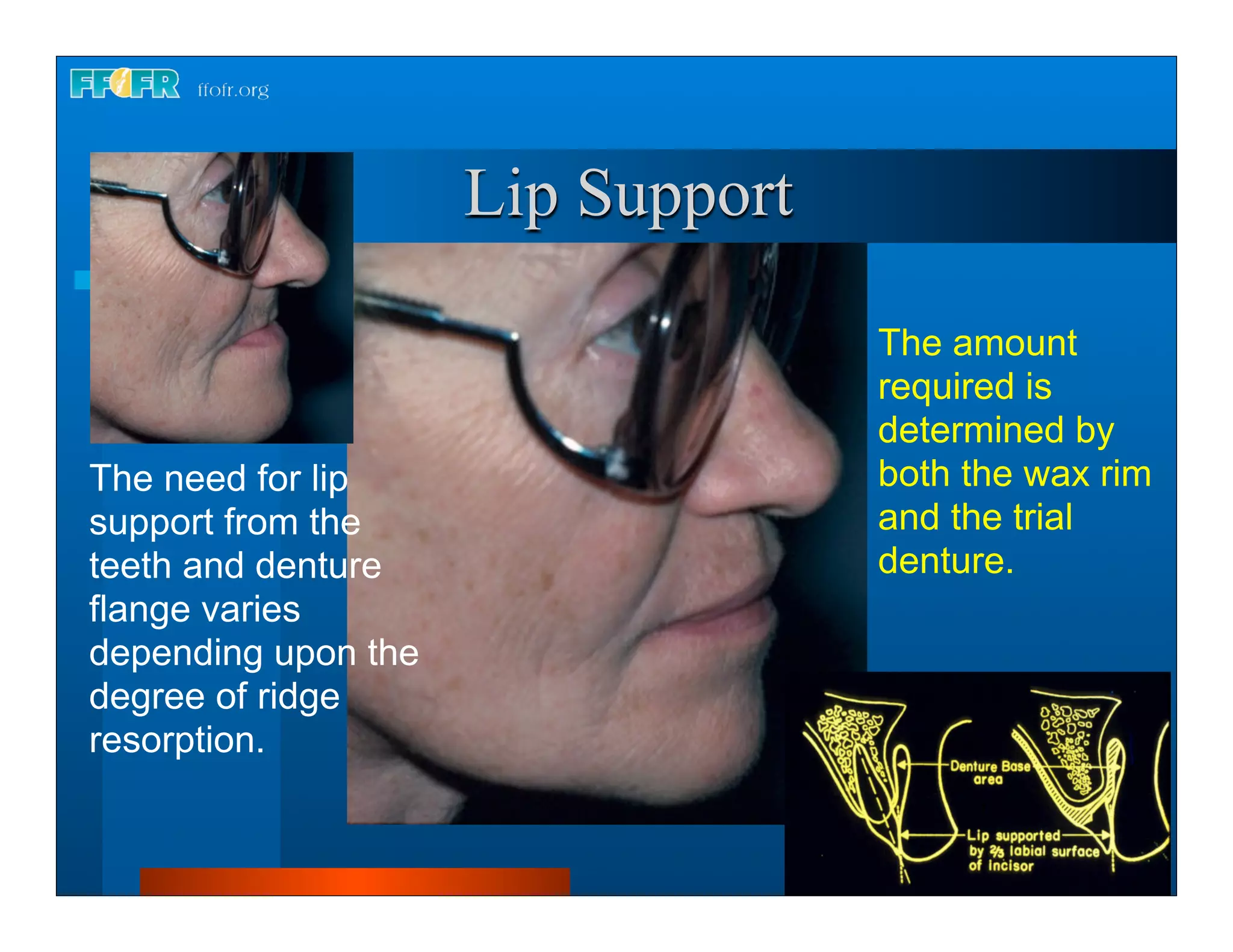 Complete dentures 16.occlusal schemes lingualized occlusion | PDF