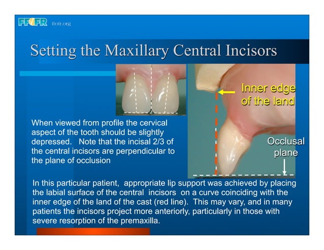 Complete dentures 16.occlusal schemes lingualized occlusion | PDF ...