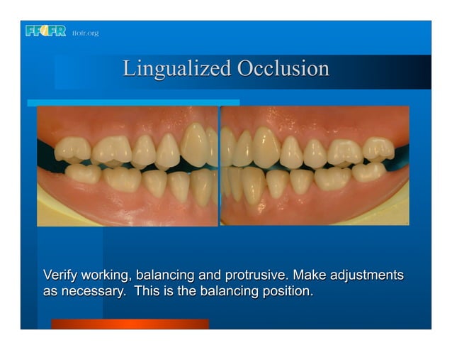 Complete dentures 16.occlusal schemes lingualized occlusion