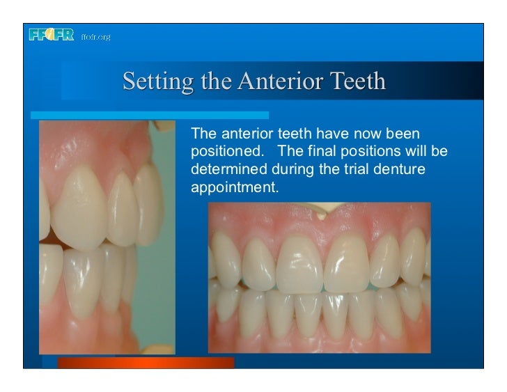 Complete dentures 16.occlusal schemes lingualized occlusion Complete dentures 16.occlusal schemes lingualized occlusion