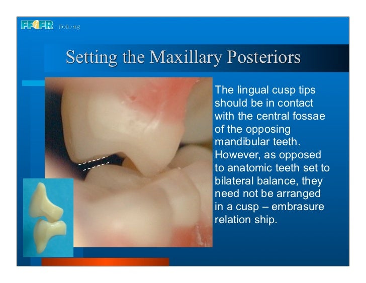 Complete dentures 16.occlusal schemes lingualized occlusion Complete dentures 16.occlusal schemes lingualized occlusion