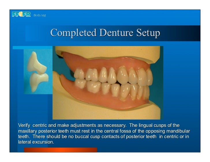 Complete dentures 16.occlusal schemes lingualized occlusion Complete dentures 16.occlusal schemes lingualized occlusion